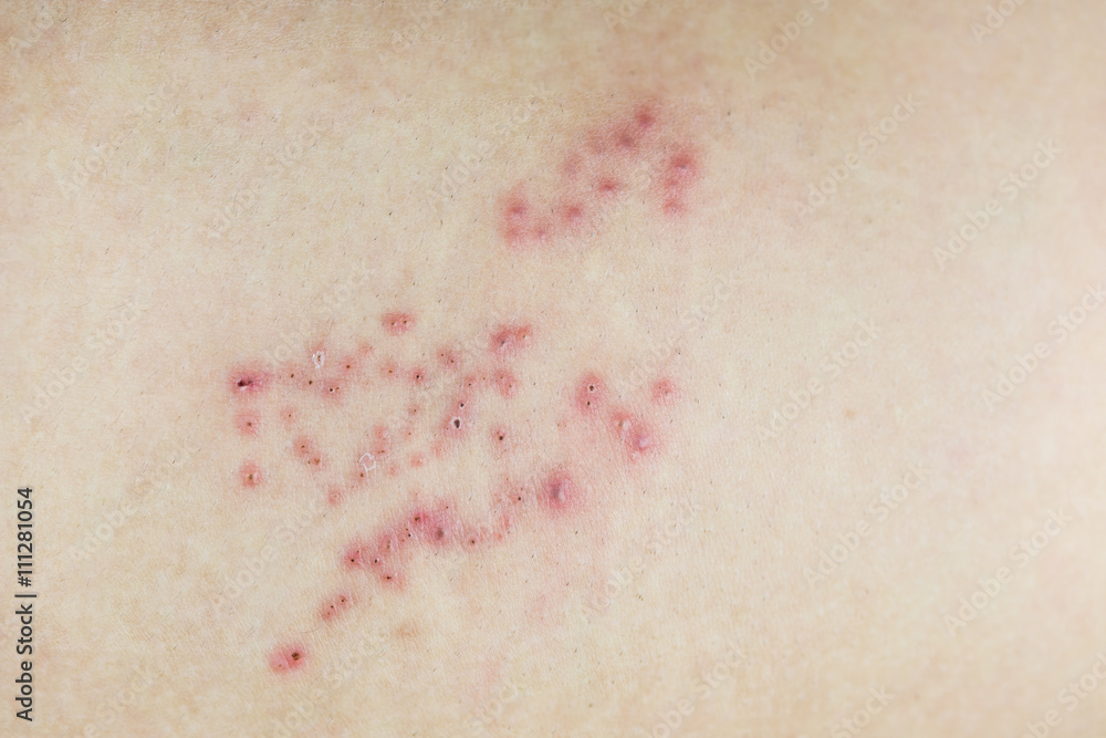 Raised red bumps and blisters on skin Stock Photo | Adobe Stock
