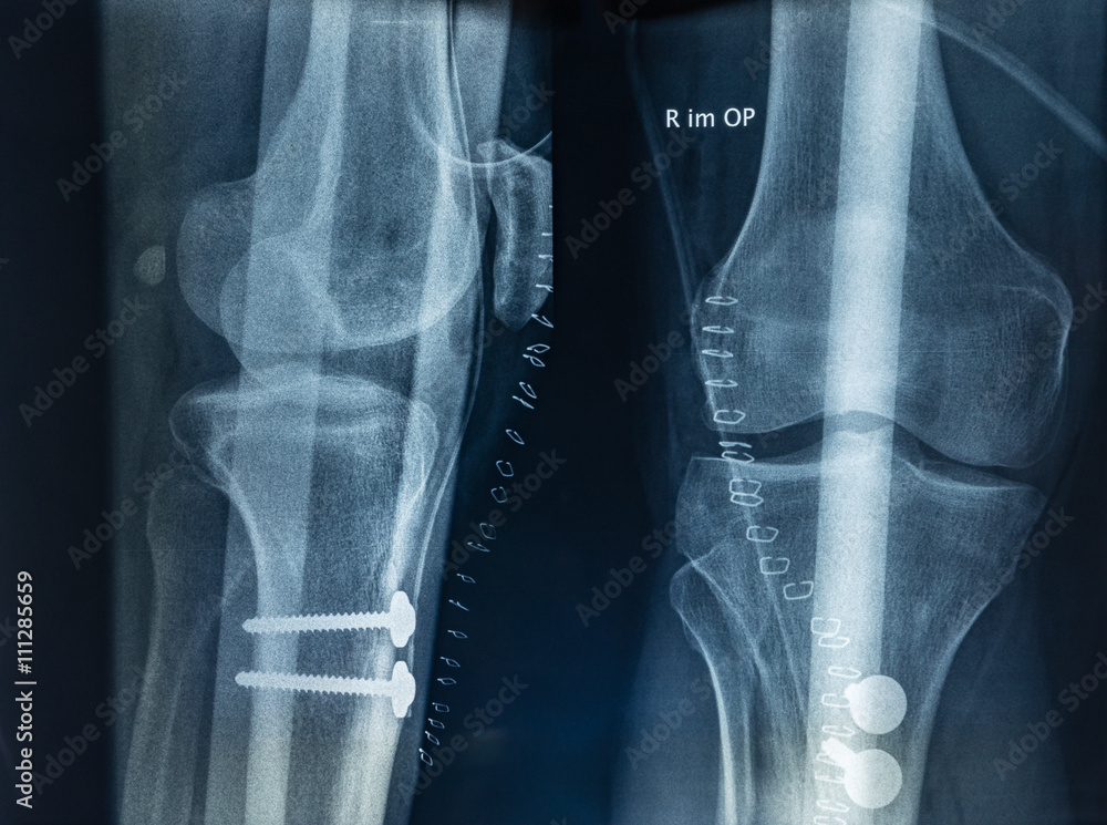 Röntgenbild nach einer Operation nach der Elmslie-Trillat Methode ...