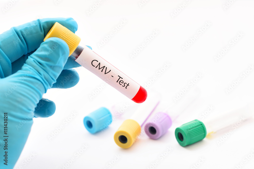 Blood for cytomegalovirus (CMV) test Stock-Foto | Adobe Stock
