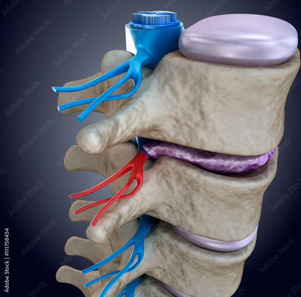Spinal cord under pressure of bulging disc Stock Illustration | Adobe Stock