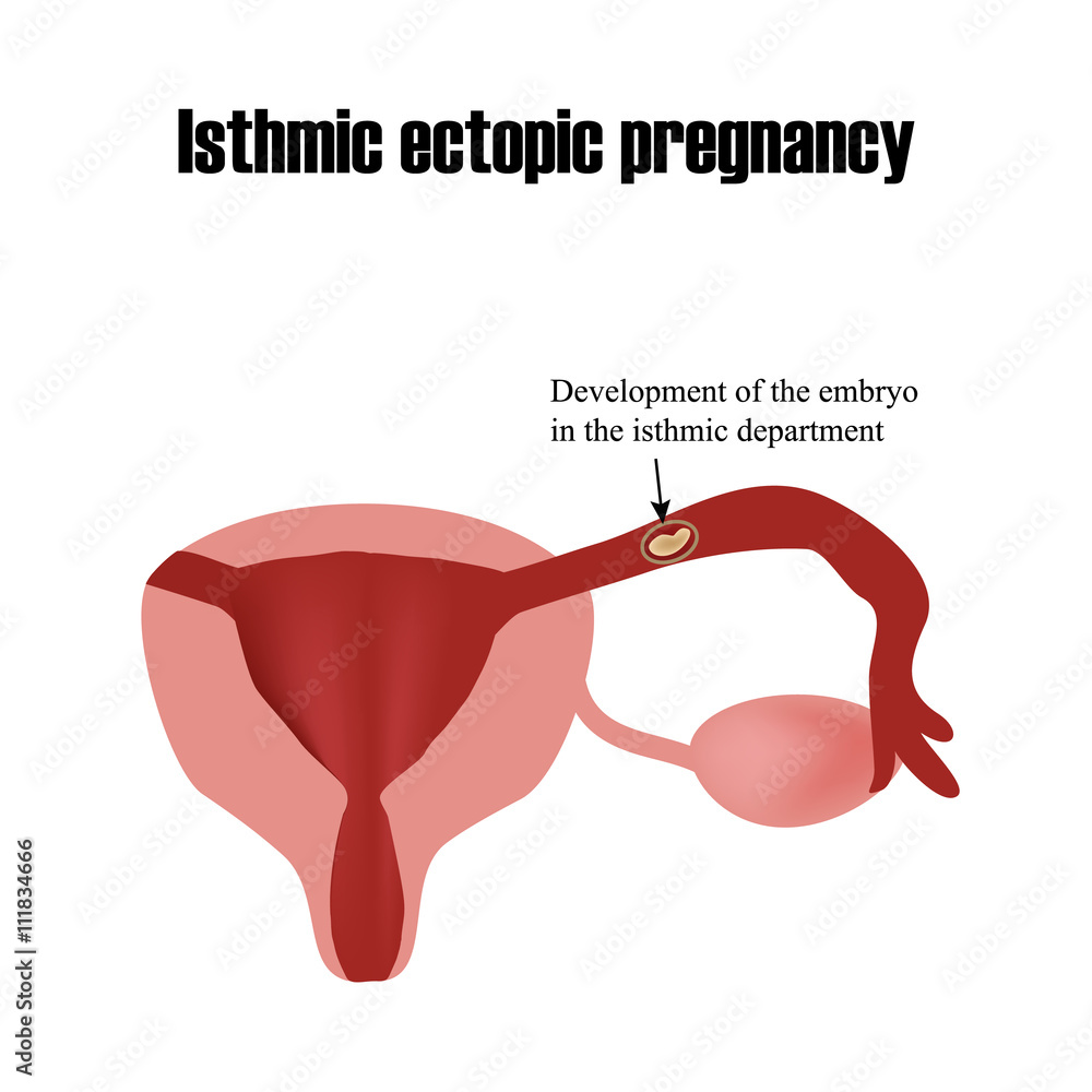 Development of the embryo in the isthmic department. Ectopic pregnancy ...