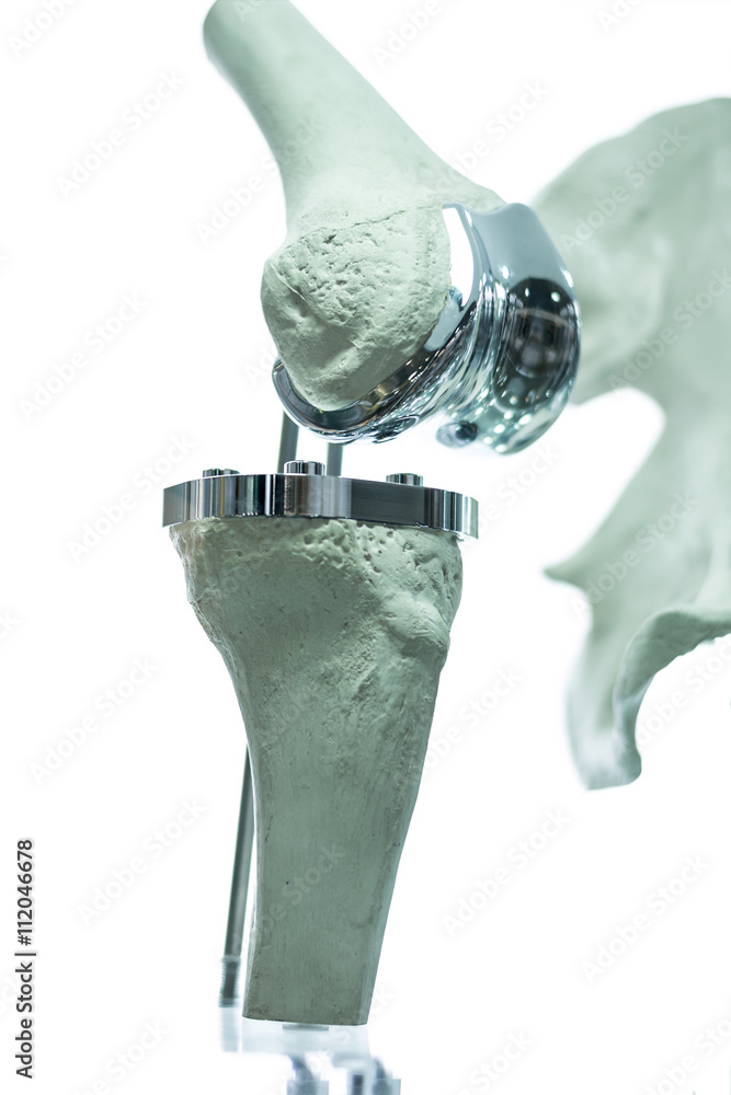 Modern knee and hip prosthesis made by cad engineer and manufactured by ...