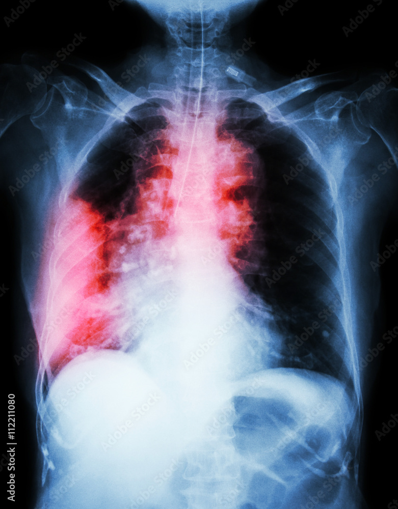 Lung cancer . Film chest x-ray show right lung mass , wide mediastinum ...