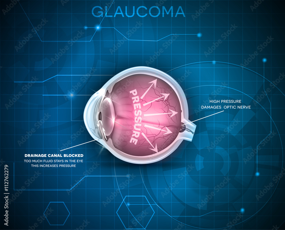 Glaucoma, vision disorder. Detailed anatomy of Glaucoma, eye disorder ...