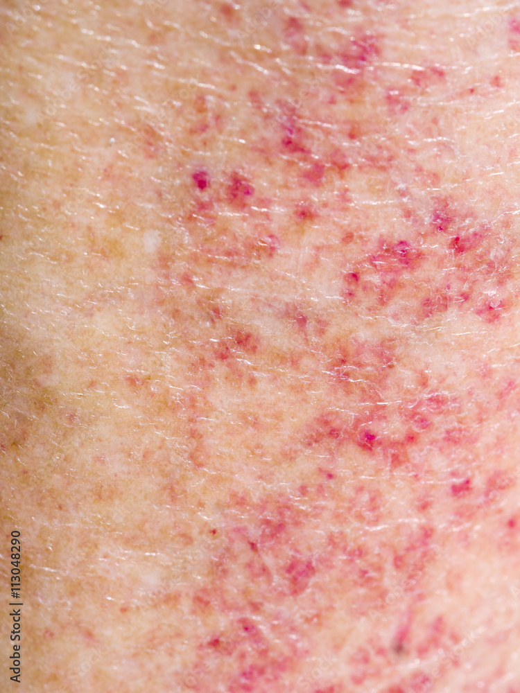 Sun adverse reaction, allergy, red rash on legs. Detail closeup. Stock ...