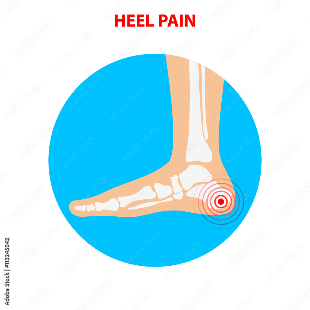 heel pain. Human ankle joint icon. Foot health care. Vector ill Stock ...
