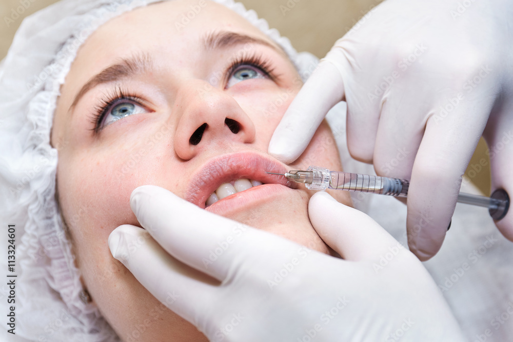Procedure of lip injection with filler. Stock Photo | Adobe Stock