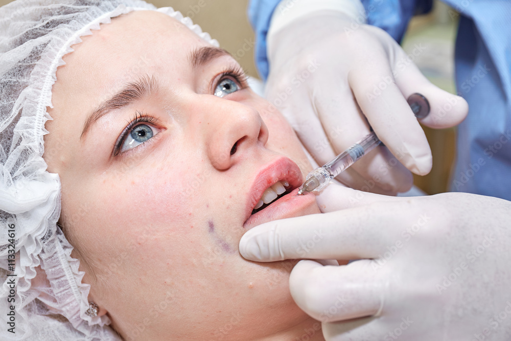 Procedure of lip injection with filler. Stock Photo | Adobe Stock