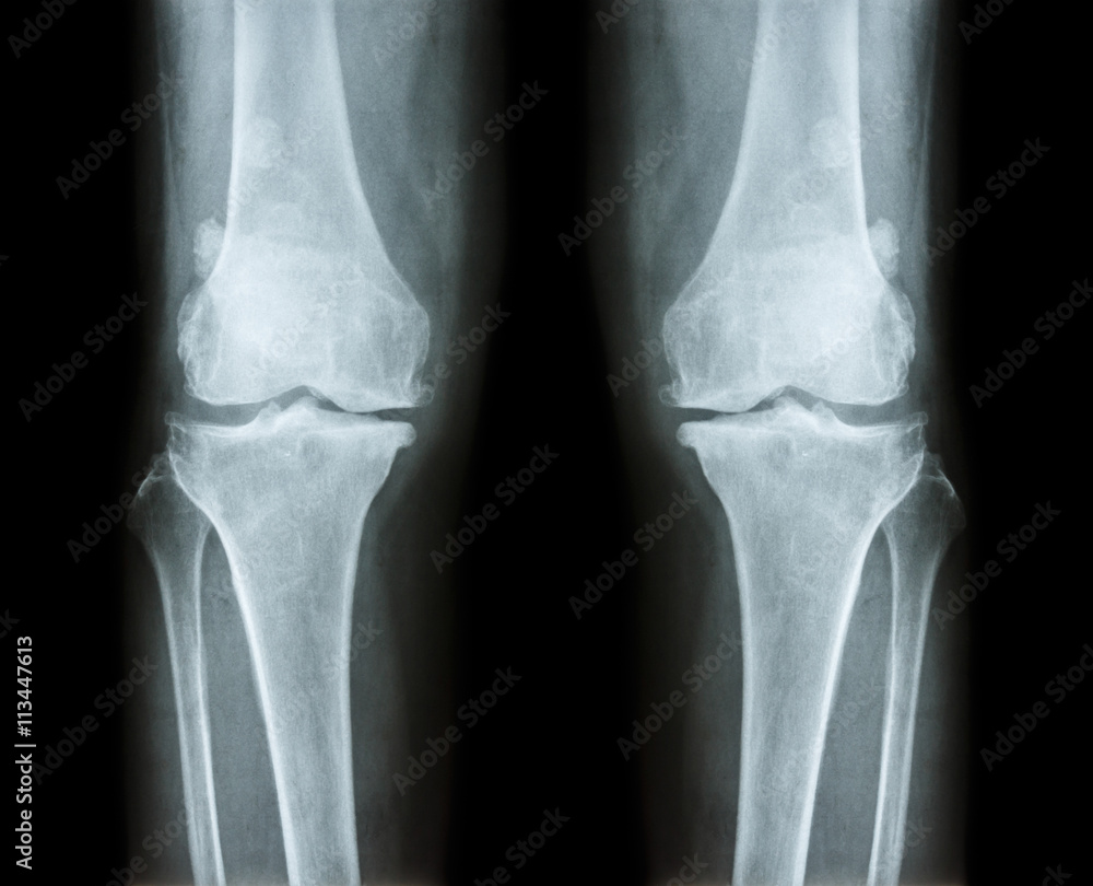 Osteoarthritis both knee . film x-ray AP ( anterior - posterior ) of ...