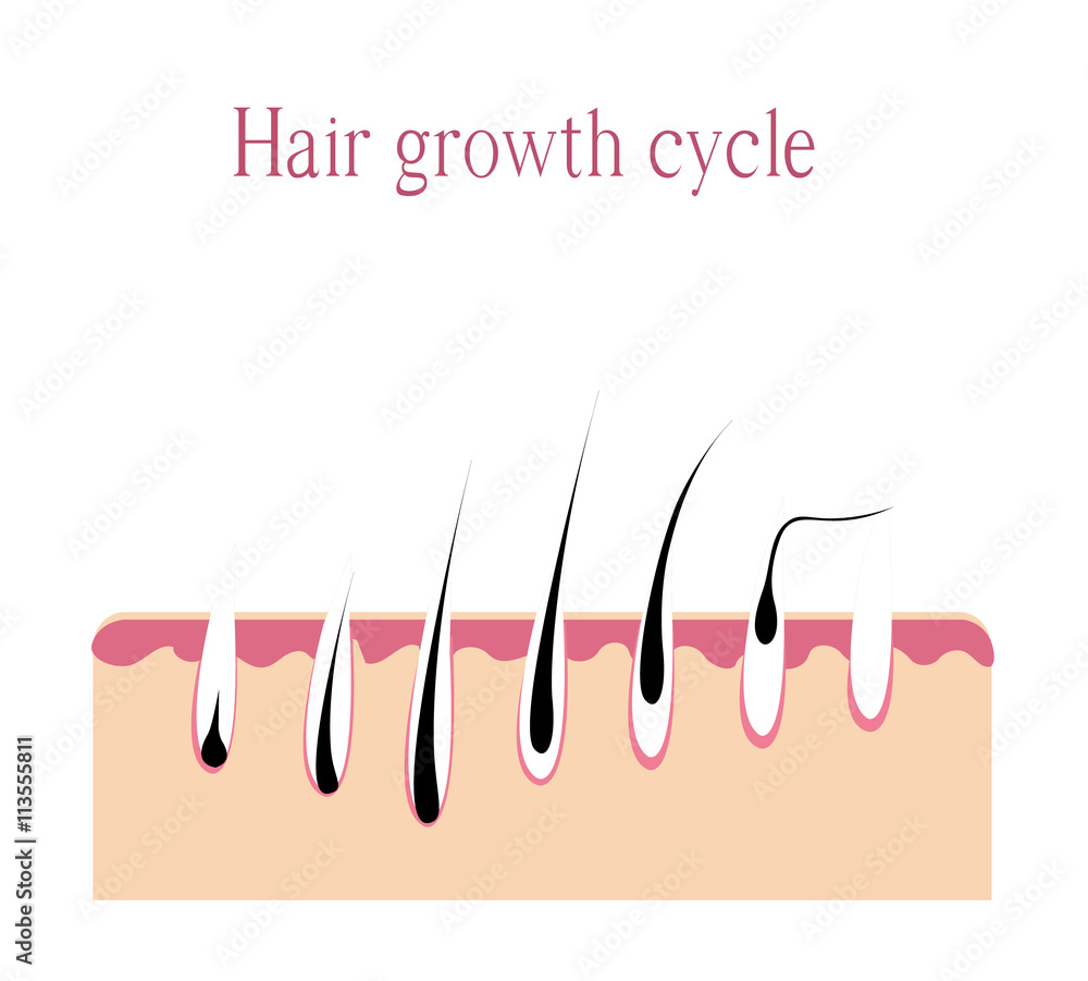 hair growth cycle. Hair loss. androgenetic Alopecia. Vector ...