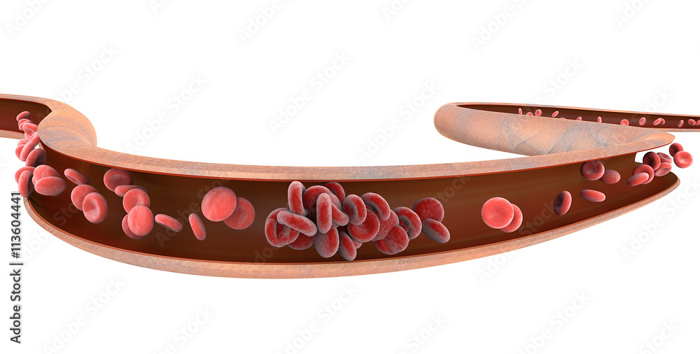 Trombosi venosa profonda, formazione di un trombo all’interno di una ...