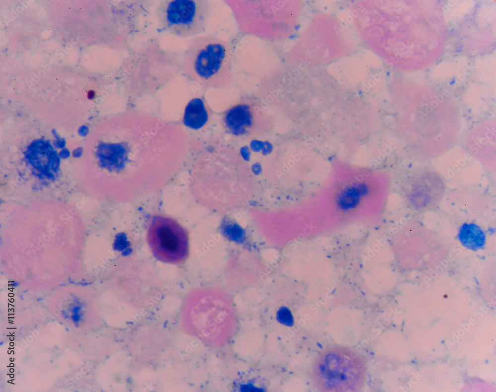 Abnormal cells pink cells with microscope. Stock Photo | Adobe Stock