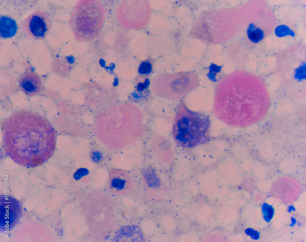 Abnormal cells pink cells with microscope. Stock Photo | Adobe Stock