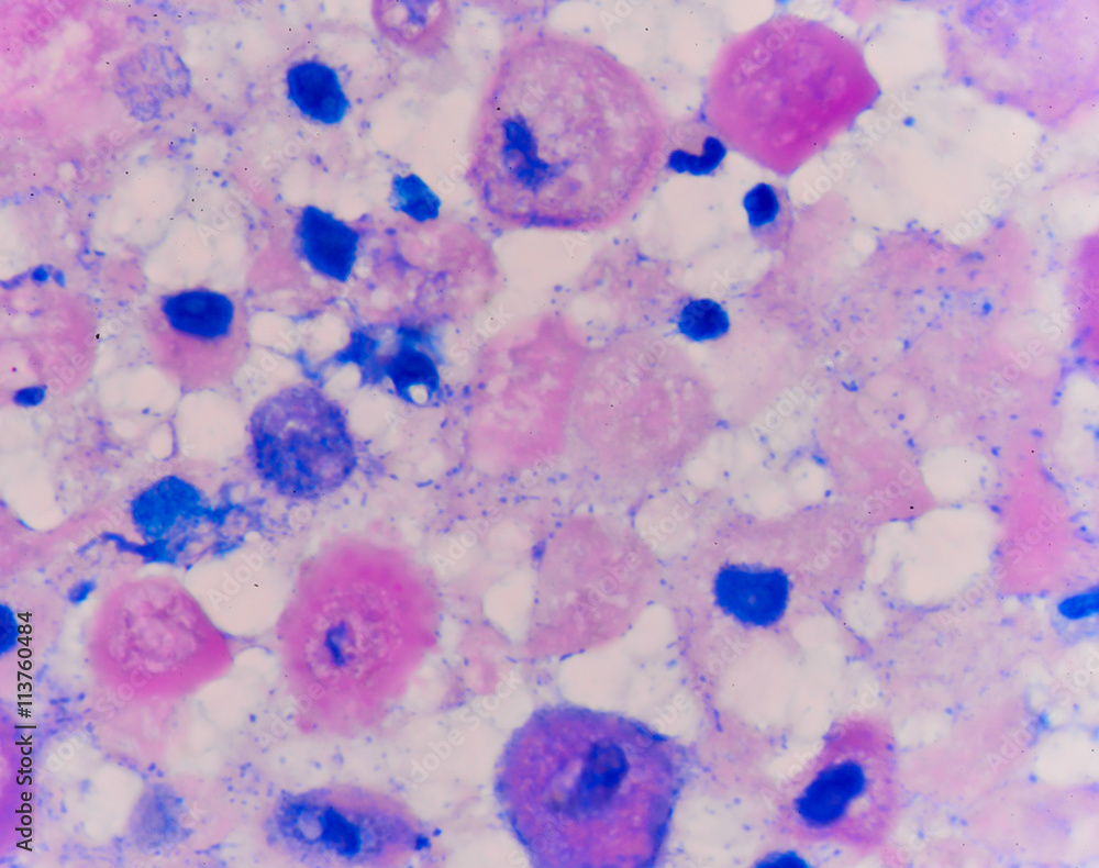 Abnormal cells pink cells with microscope. Stock Photo | Adobe Stock