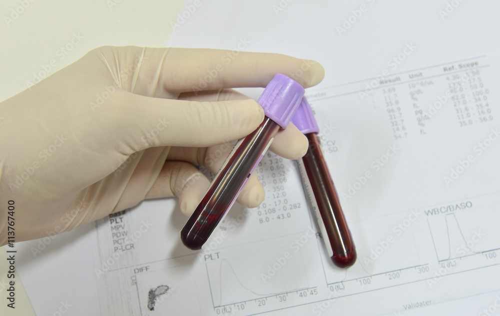 Blood test for Complete Blood Count. CBC Stock Photo | Adobe Stock