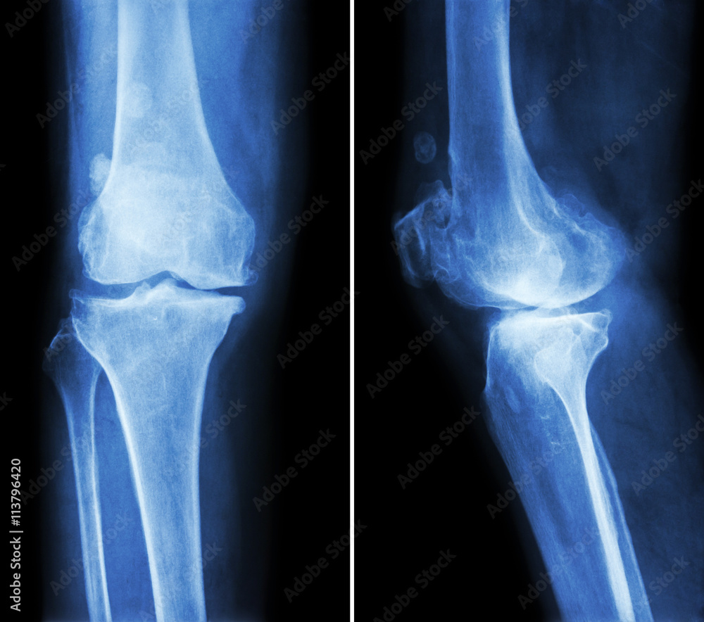 Osteoarthritis knee . film x-ray knee ( anterior - posterior and ...