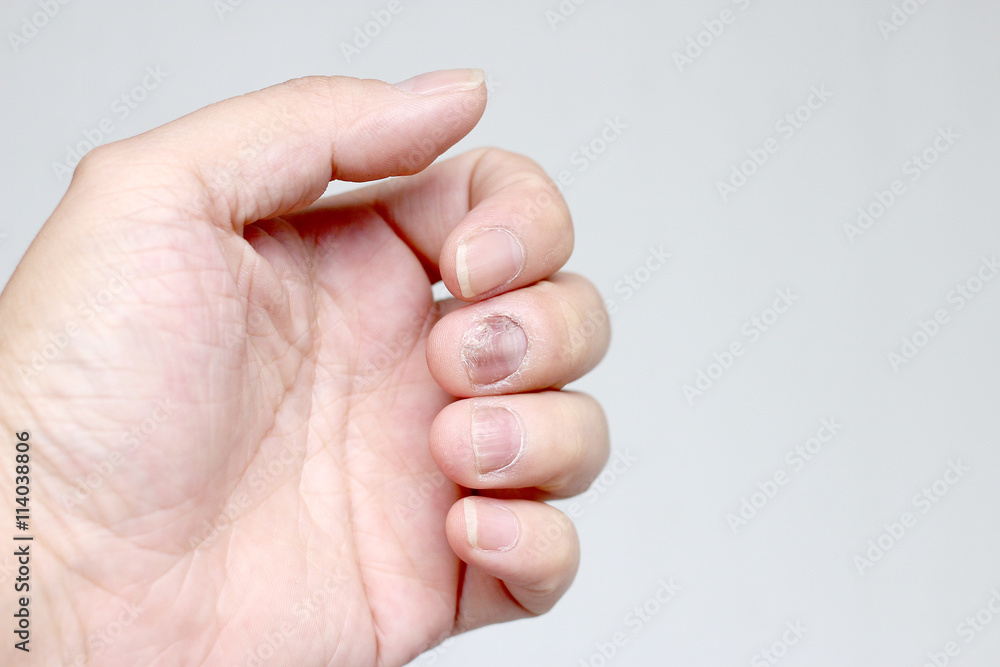 Fungus Infection on Nails Hand, Finger with onychomycosis. - soft focus ...