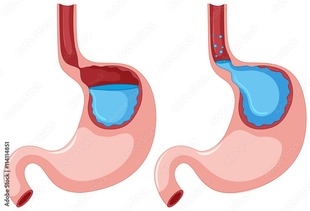 Diagram of Gastroesophageal Reflux Disease Stock Vector | Adobe Stock