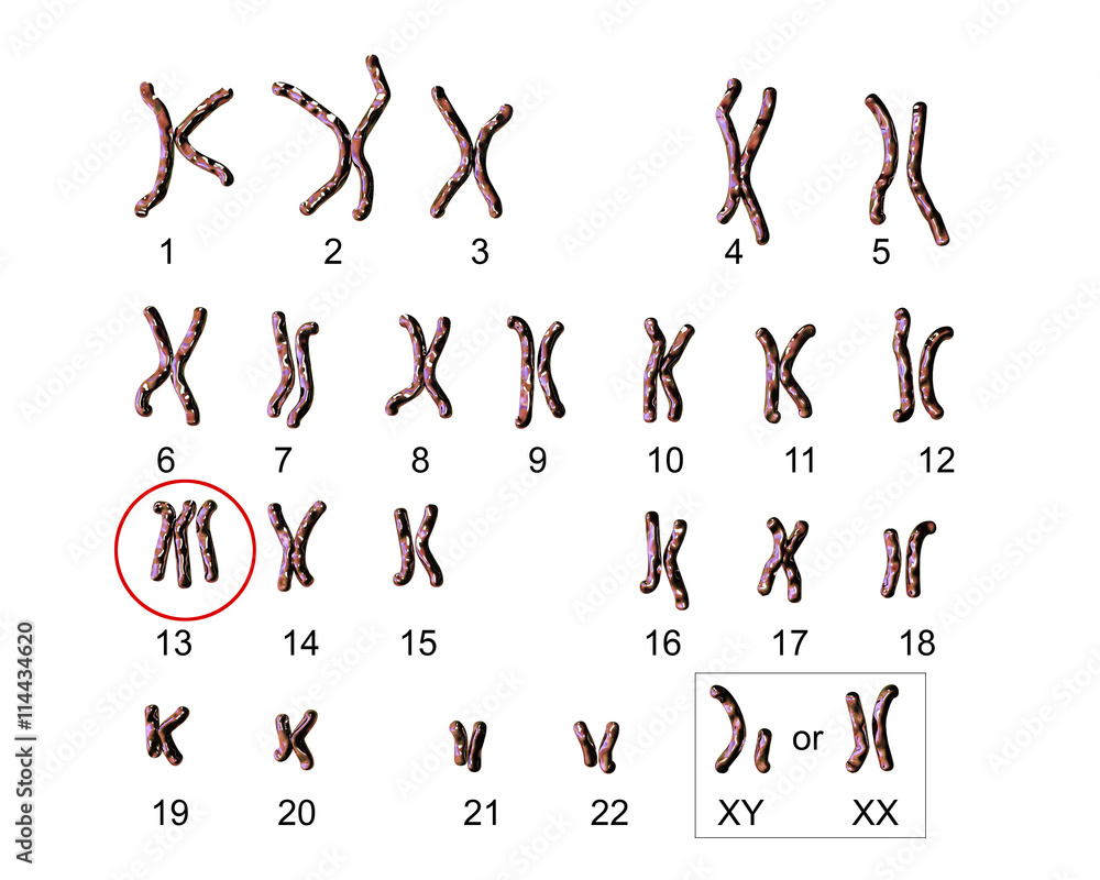 Trisomy 13
