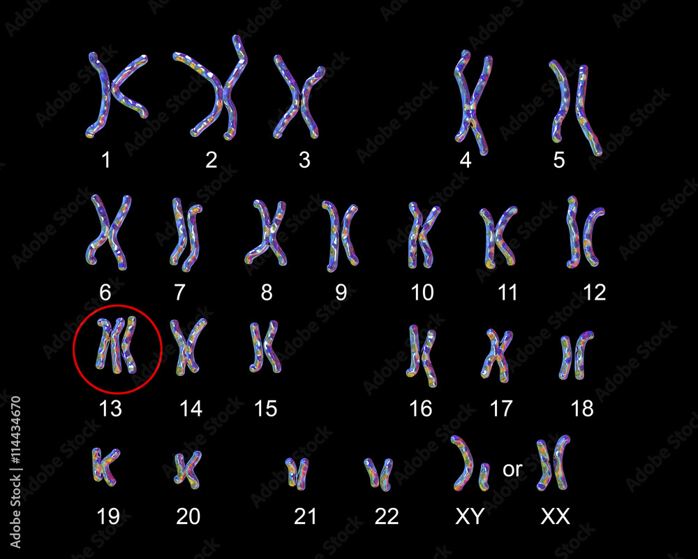 Patau-syndrome karyotype, labeled. Trisomy 13. 3D illustration Stock ...
