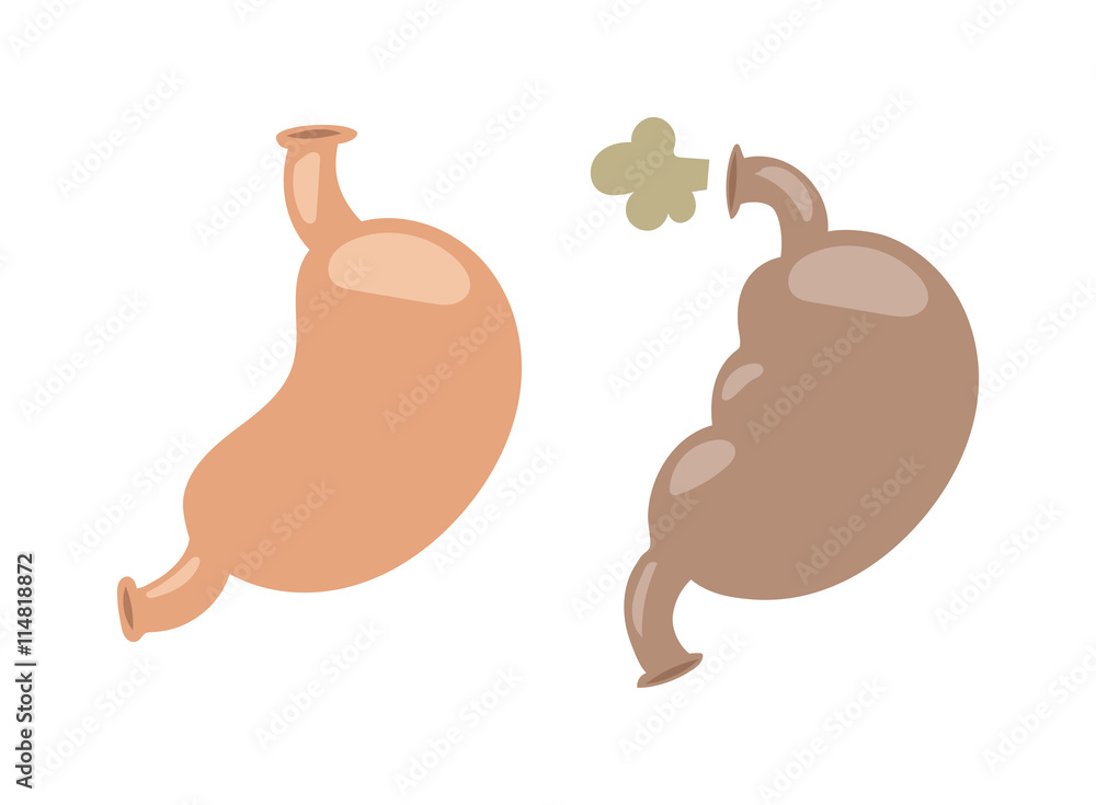 Bloating digestive problems medicine pain health. Anatomy gastric organ ...