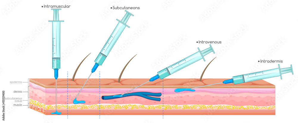 Diagram showing injection with syringe Stock Vector | Adobe Stock