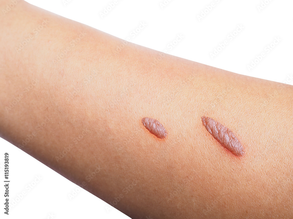 Blisters on skin by scalding Stock Photo | Adobe Stock