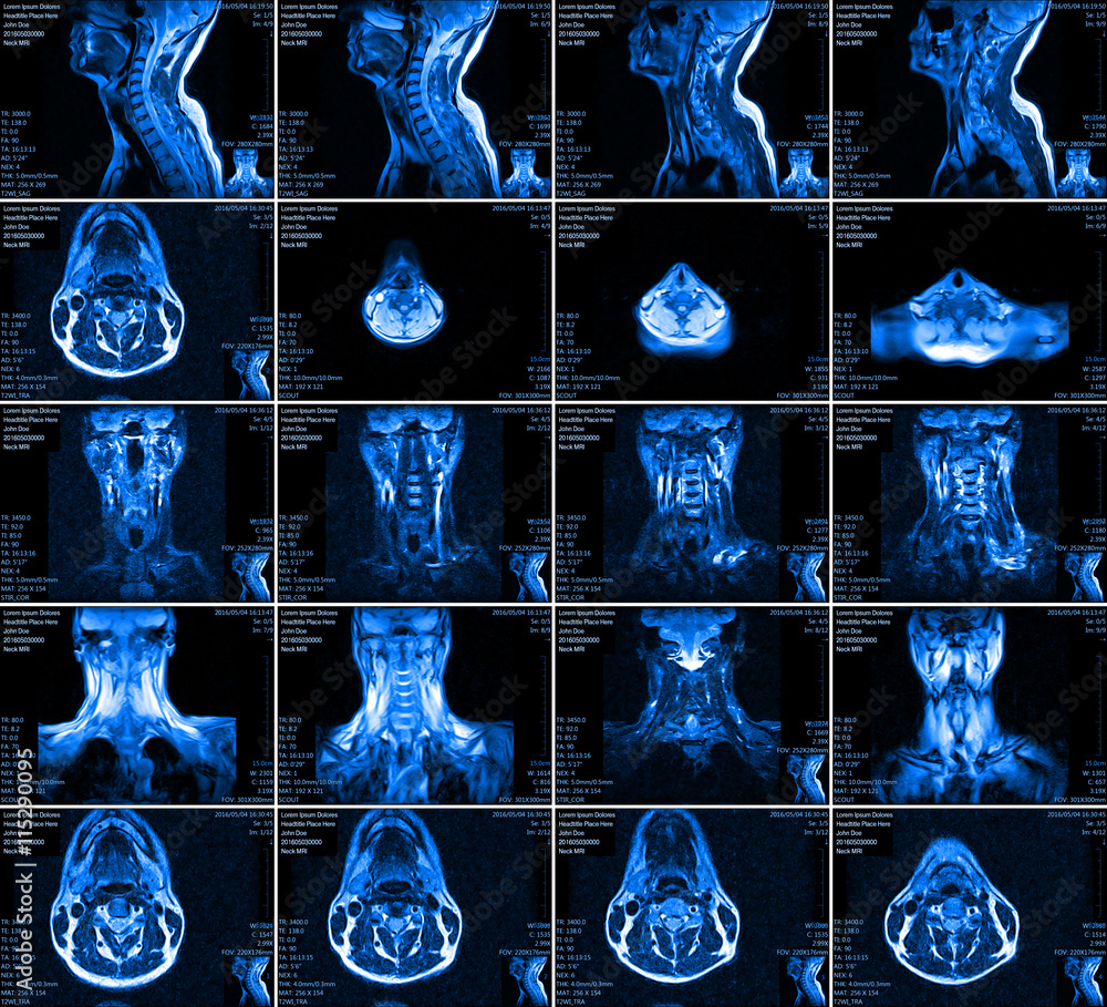 Magnetic resonance imaging of the cervical spine. Stock Photo | Adobe Stock