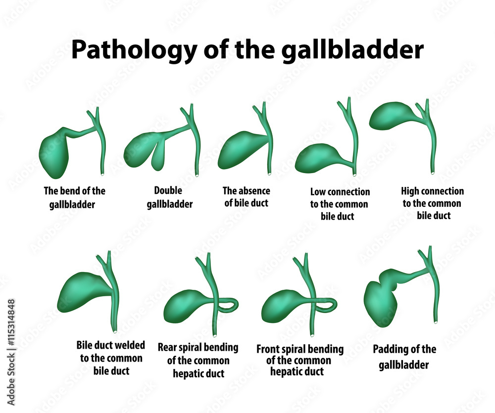 Pathology of the gallbladder. The bend of the gallbladder. Set. Vector ...