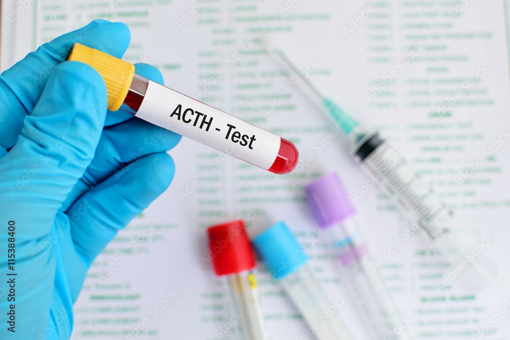 Blood sample for adrenocorticotropic hormone (ACTH) test foto de Stock ...