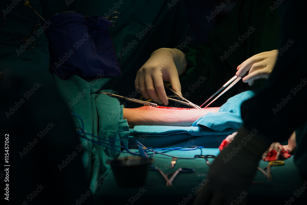 Surgery for Coronary Artery Bypass Grafting: CABG Stock Photo | Adobe Stock