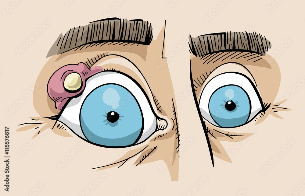 Cartoon of a close up of a stye on the eyelid of a person's eye. Stock ...