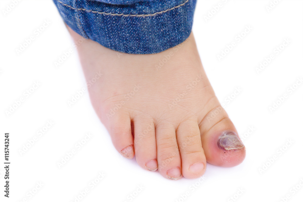 Blauer Zehennagel am Fuß eine Kindes auf weißem Hintergrund Stock Photo ...