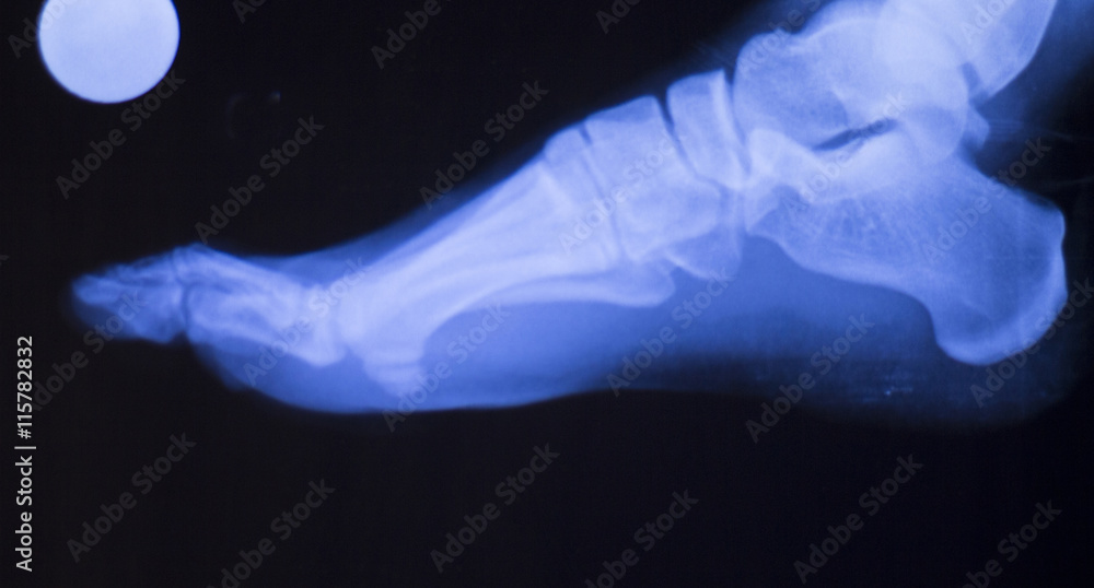 Foot ankle injury xray scan Stock Photo | Adobe Stock