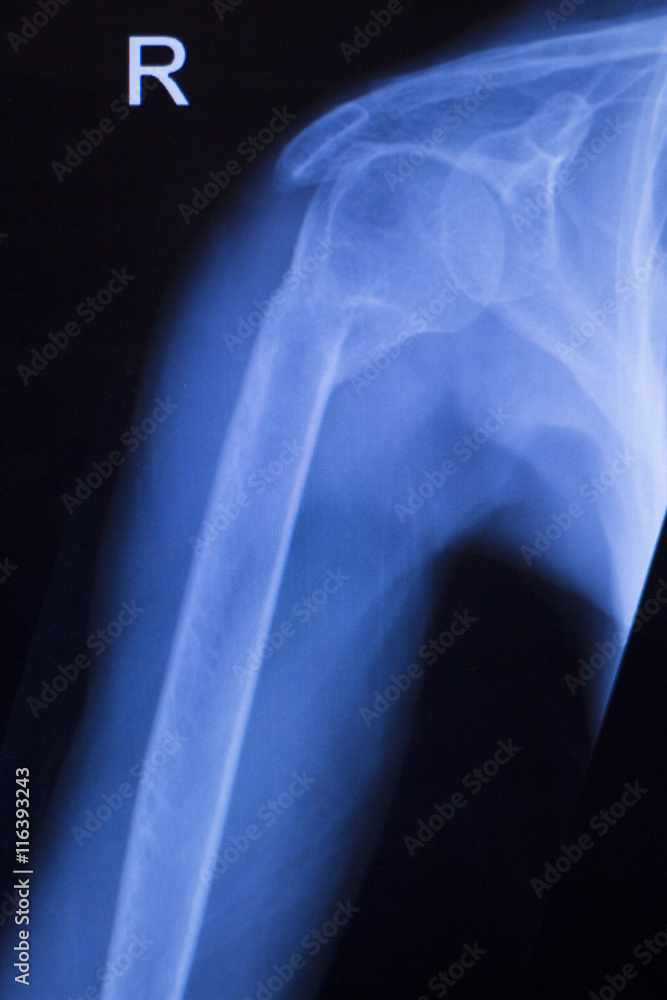 Shoulder joint orthopedic xray scan Stock Photo | Adobe Stock