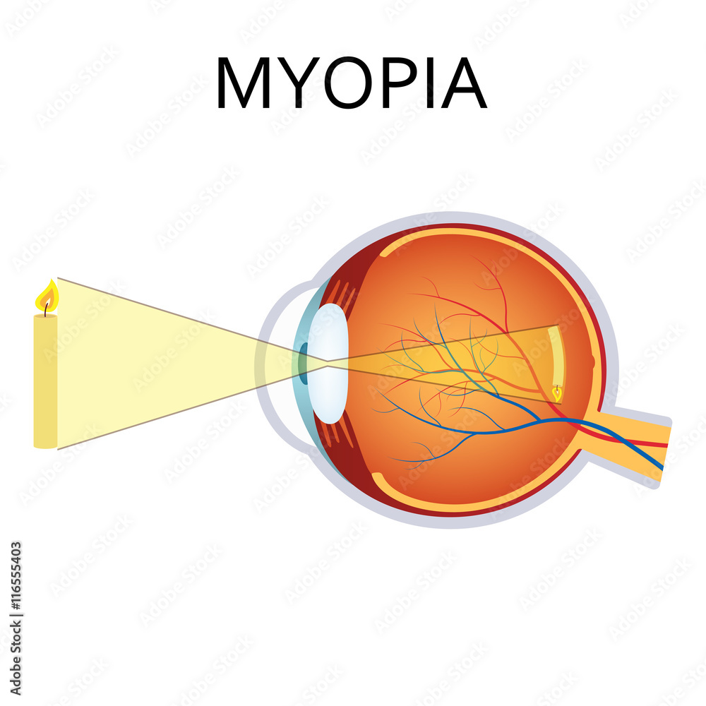 Illustration of myopia. Stock Vector | Adobe Stock