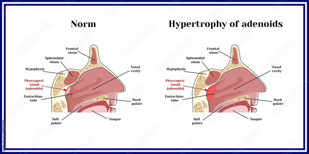 Location of adenoids.The structure of the nasopharynx. Norm and ...