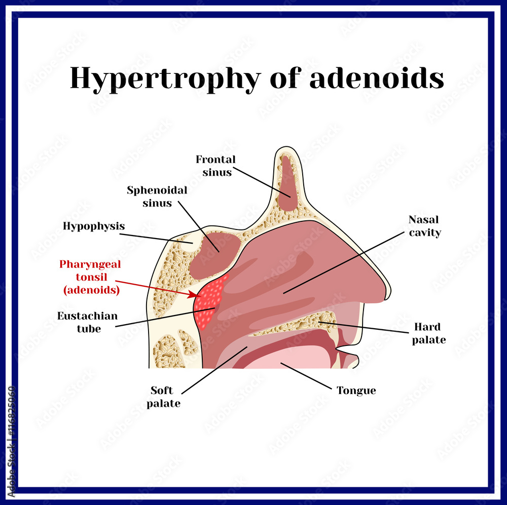 Location of adenoids.The structure of the nasopharynx. Hypertrophy of ...
