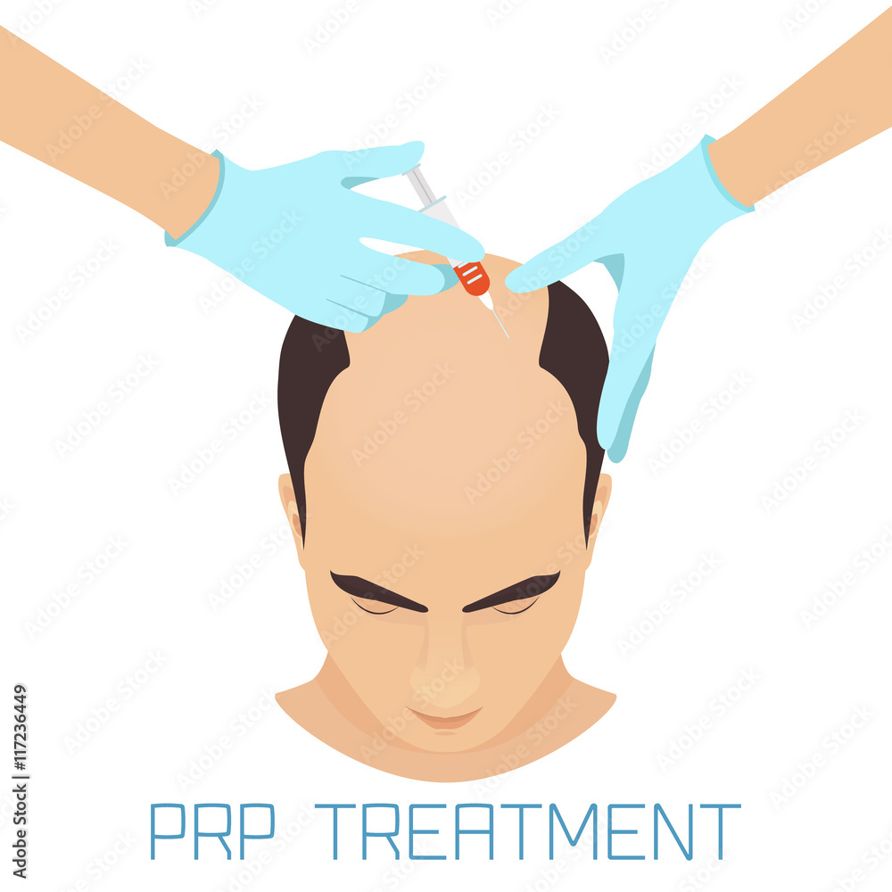 Platelet rich plasma injection procedure for balding men. PRP treatment ...