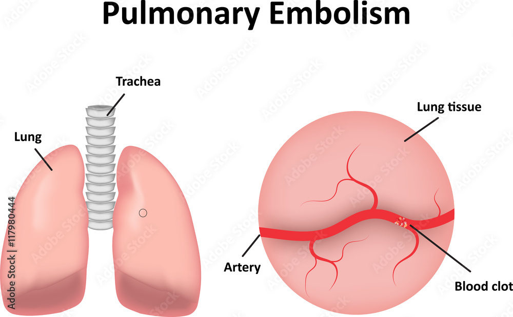 Pulmonary Embolism labeled Diagram Stock Vector | Adobe Stock