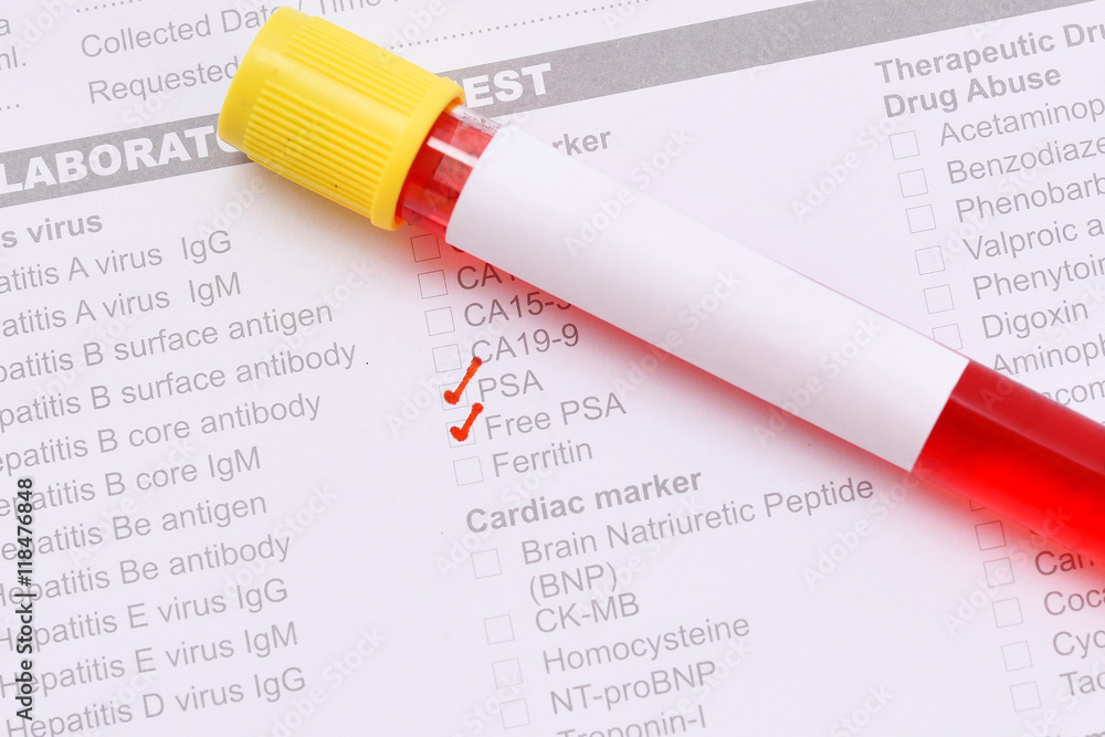 Blood sample for PSA test, prostate cancer diagnosis Stock Photo ...