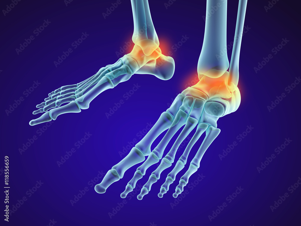 Skeletal foot - injuryd talus bone. Xray view. Medically accurate 3D ...