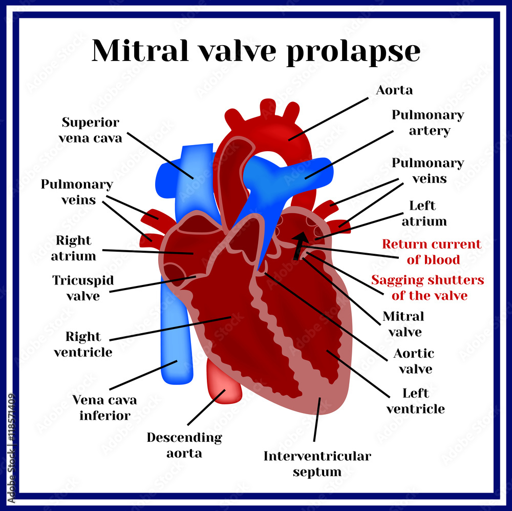 Heart structure. Mitral valve prolapse. Cardiac pathology. Stock Vector ... Heart structure. Mitral valve prolapse. Cardiac pathology. Stock Vector ...