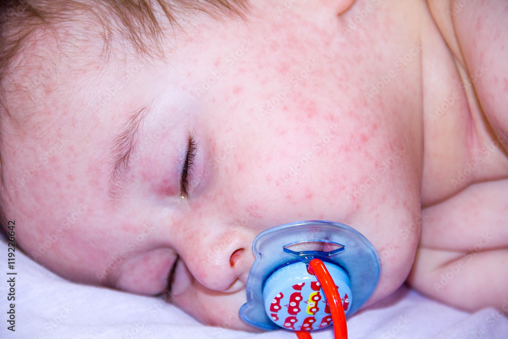 baby with dermatitis problem of rash. Allergy suffering from food ...