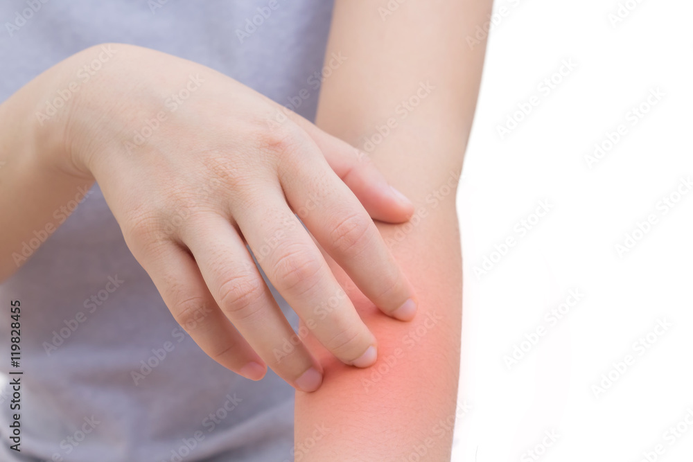 Woman has skin rash itch on arm Stock Photo | Adobe Stock