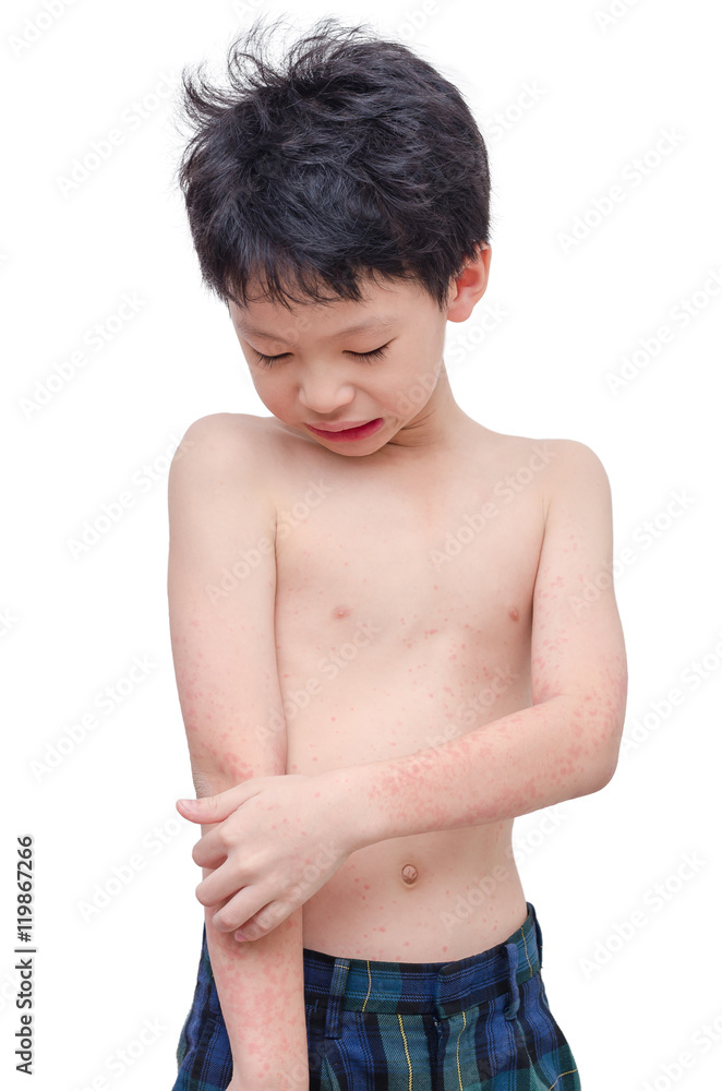 Young asian boy screatching his arm with rash over white Stock Photo ...