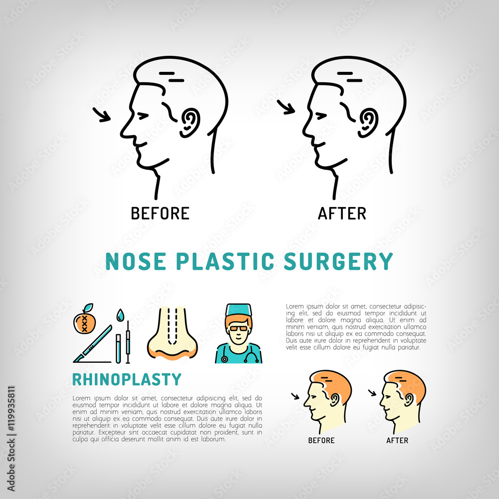 Vettoriale Stock Rhinoplasty Nose Plastic Surgery logos. Face Plastic ...