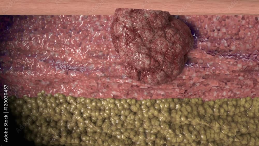 Cancer cell growth animation. Tumor growing under skin tissue. Stock ...