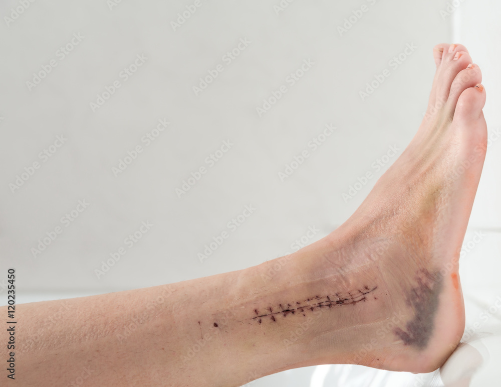 Knochenbruch am Fuss - Wadenbein Stock-Foto | Adobe Stock