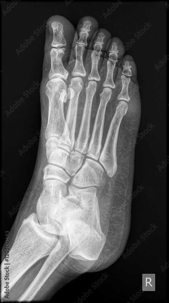 Side-Lateral view radiograph of human right foot Stock Photo | Adobe Stock